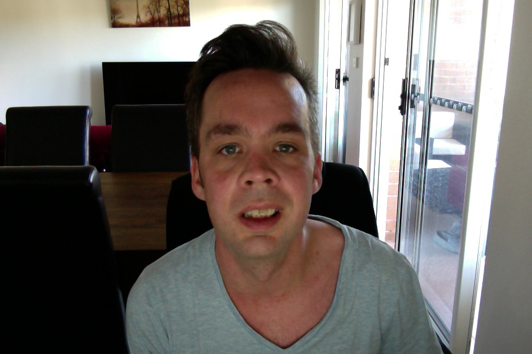 Jaw Surgery Journey: SARME surgery post-op day three - I've started ...