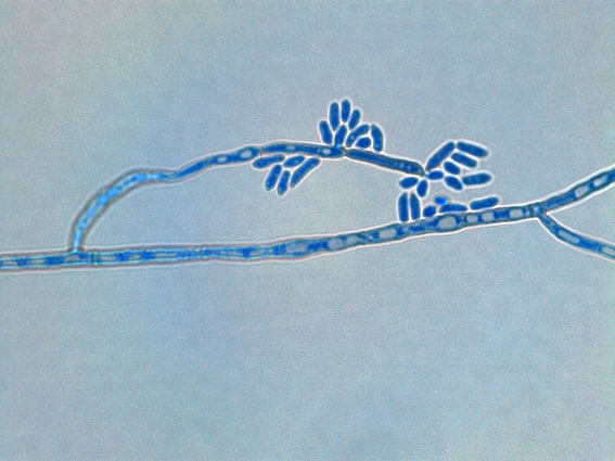 Fun With Microbiology (What's Buggin' You?): Exophiala dermatitidis