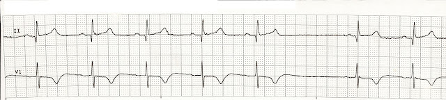 EKG Rhythm Strips 57