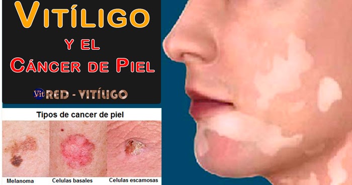 ¿El Vitiligo puede provocar Cáncer de Piel?