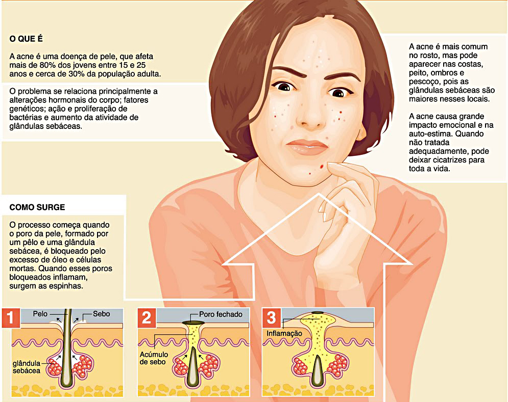 O Que Você Precisa Saber Sobre: Acne ~ Ao Ponto Com Elas