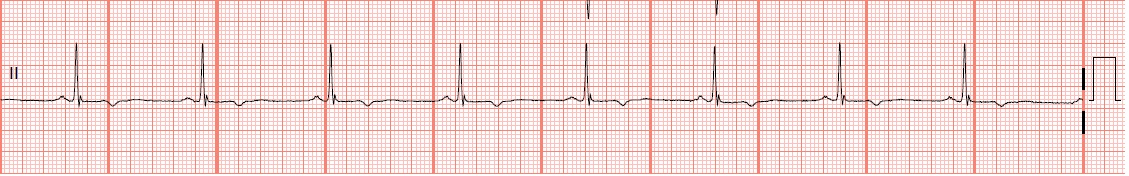 EKG Rhythm Strips 15: Sinus Rhythms