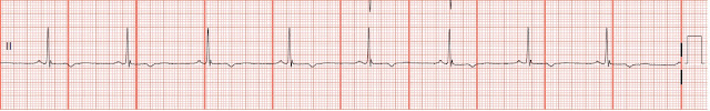 EKG Rhythm Strips 15: Sinus Rhythms
