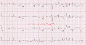 Multifocal Atrial Tachycardia Strip