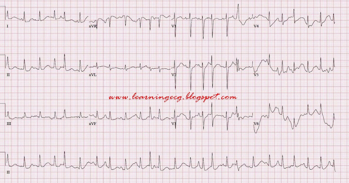 ECG Rhythms: Multifocal atrial tachycardia (MAT)/ Chaotic atrial ...