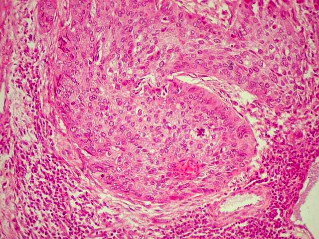 Patología 2014- Pilar Herranz: Carcinoma epidermoide