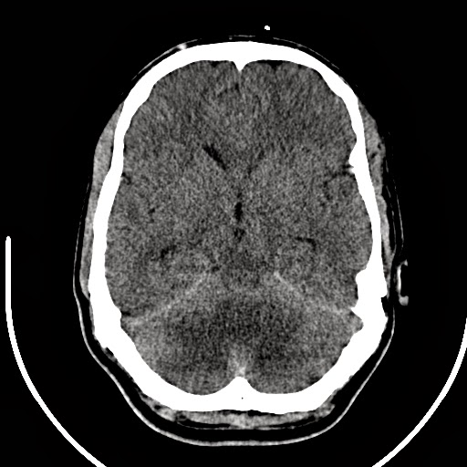 Ultimate Radiology : Bilateral thalamic and cerebellar hypodensity