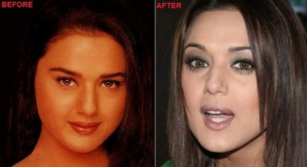 Preity Zinta Plastic Surgery
