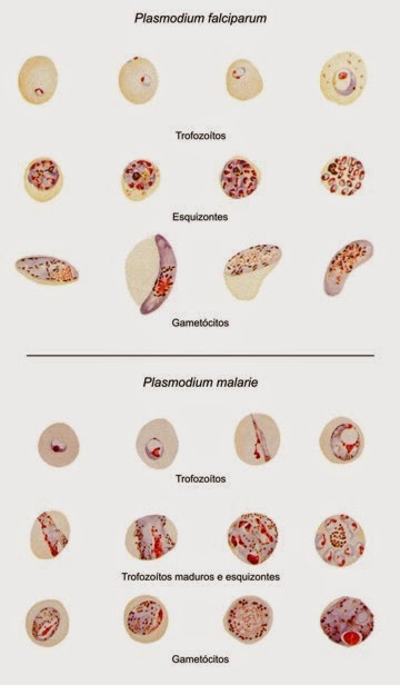 FICHERO DE HEMATOLOGÍA: ANORMALIDADES ERITROCITARIAS. Anormalidades de ...