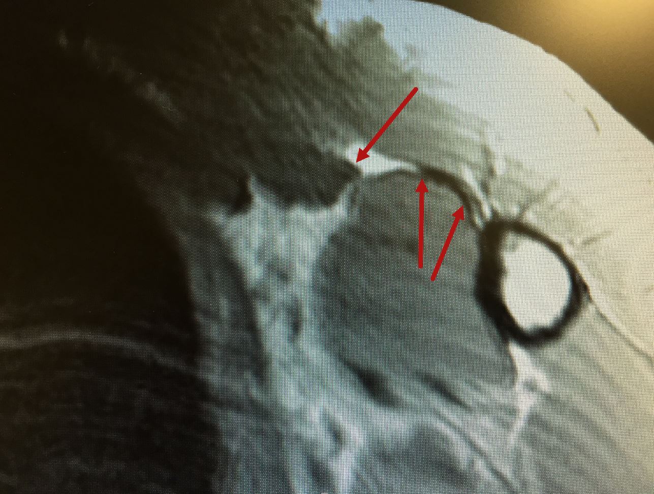 Did I tear my pec tendon?