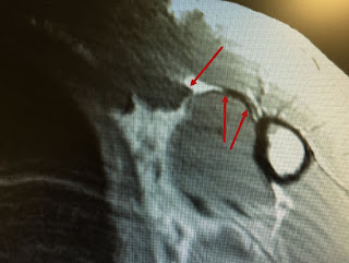 Did I tear my pec tendon?