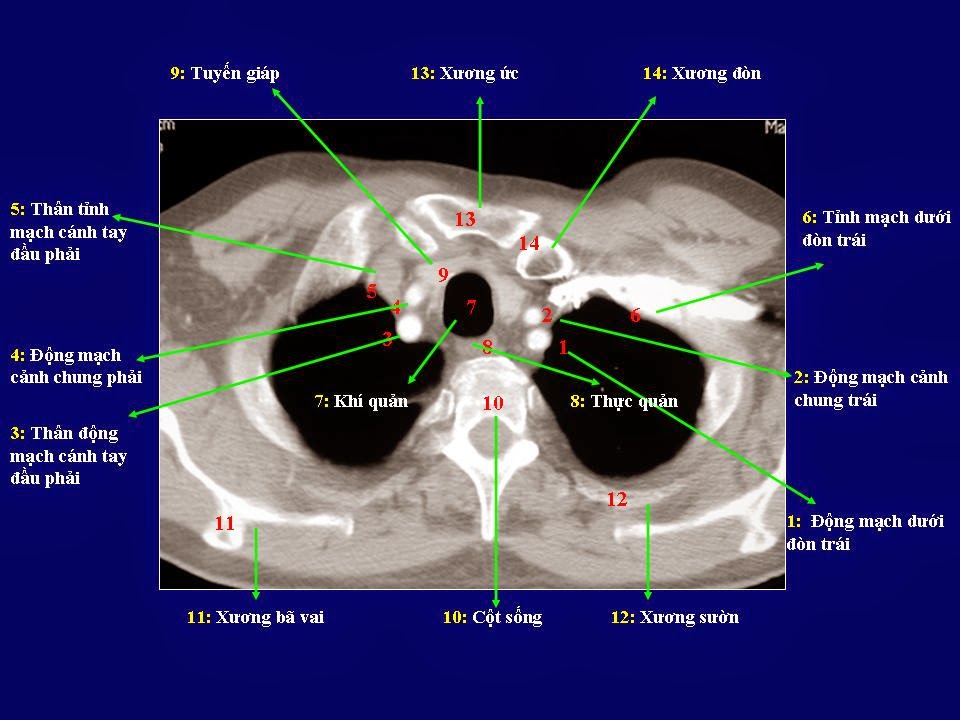 Giải phẫu CT lồng ngực ~ Chẩn đoán hình ảnh