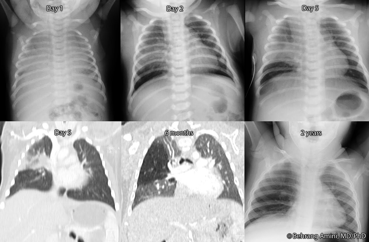 Roentgen Ray Reader: Congenital Lobar Emphysema