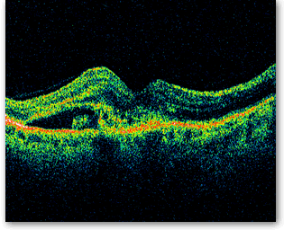 DEGENERACION MACULAR : DMAE SECA. OCT DE CONTROL