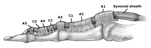 ZONA DE SALUD DE OFRA: TENOSINOVITIS ESTENOSANTE DEL TENDÓN FLEXOR ...