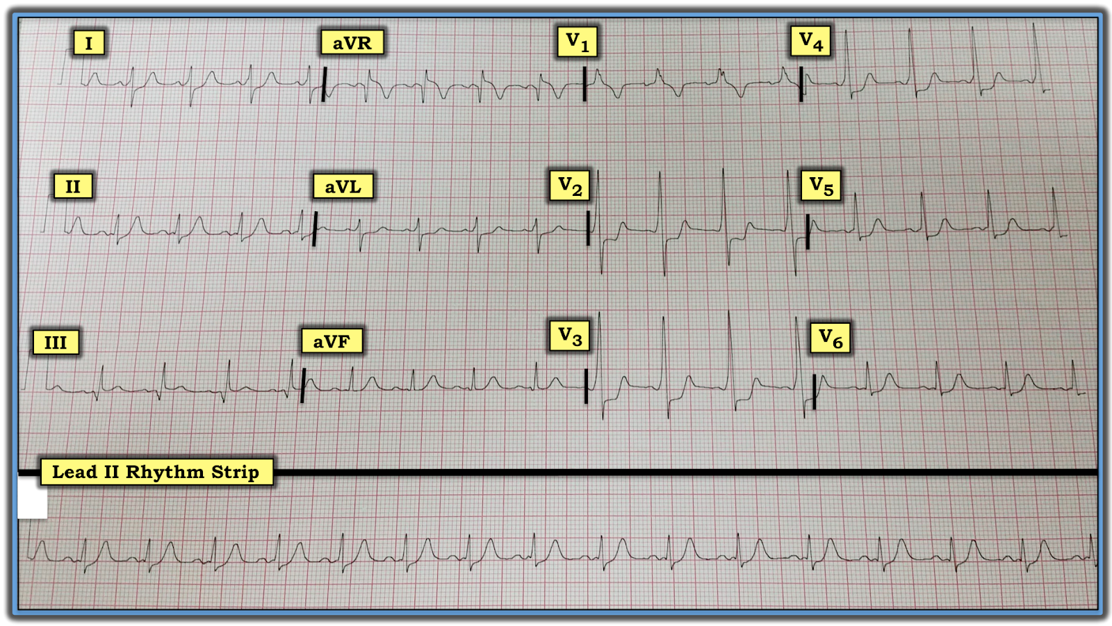 ECG Interpretation: ECG Blog #157 (RBBB - LBBB- WPW - RVH - ST depression)
