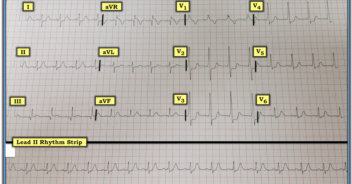 ECG Interpretation: ECG Blog #157 (RBBB - LBBB- WPW - RVH - ST depression)