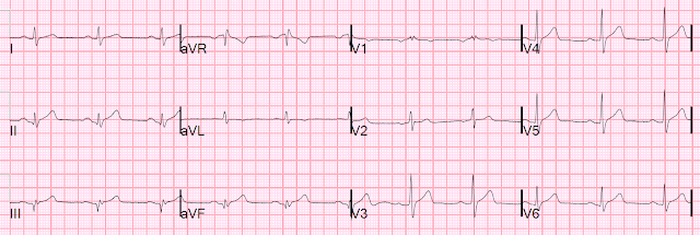 Dr. Smith's ECG Blog: Our residents are getting really good at this.