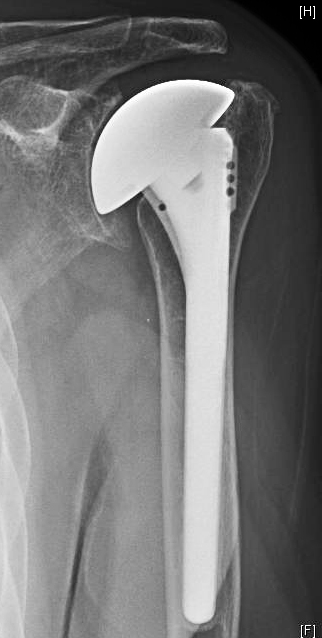 UW Shoulder and Elbow Academy: Ream and run at 10 years after surgery