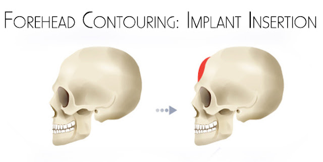 ID Hospital Korea: Do you have a 'Flat Forehead'? - forehead, forehead ...