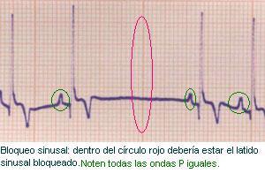 Electrocardiograma y Medicina General: Bloqueo sinusal