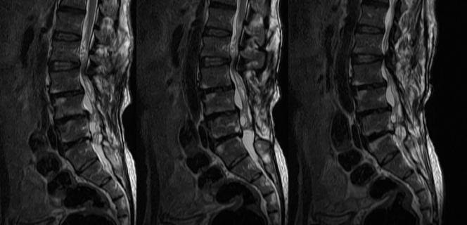 Neuroradiology Cases: Arachnoiditis MRI Lumbar spine