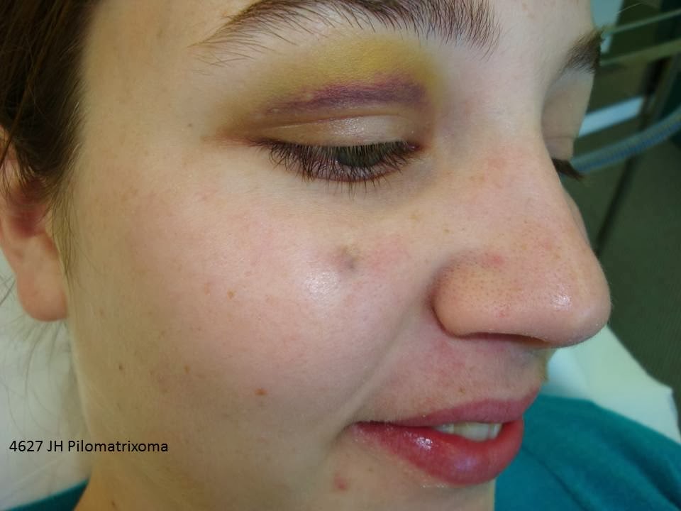 Dermpath Made Simple - Neoplastic: Pilomatrixoma