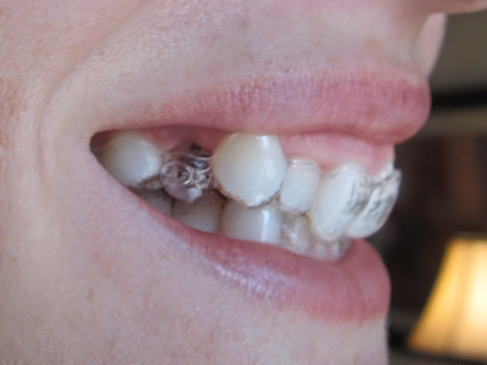 Creatively Titled Blog about Invisalign: Tray 1