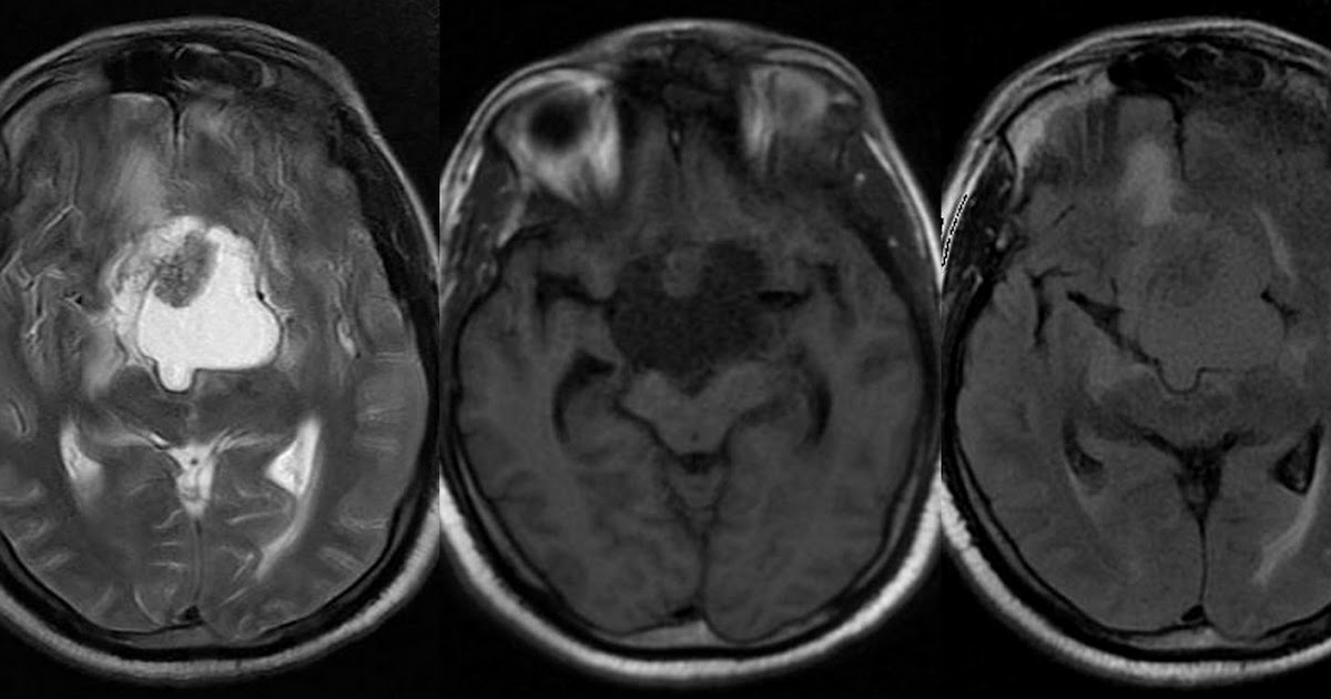 Neuroradiology Cases: Craniopharyngioma