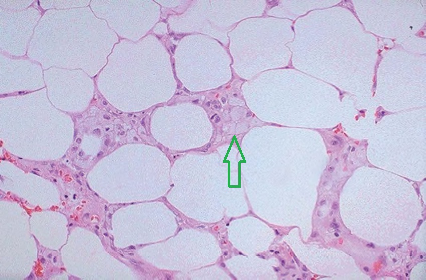 Necrosis Grasa Macroscópica