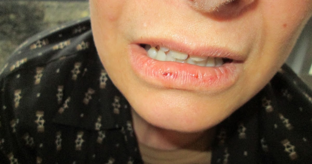 Legal Schnauzer: Photograph shows Carol's split lip, likely the result ...