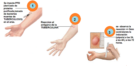 TUBERCULOSIS LATENTE Y LETAL: TUBERCULOSIS PULMONAR