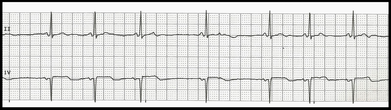 Float Nurse: Practice Rhythm Strips 275