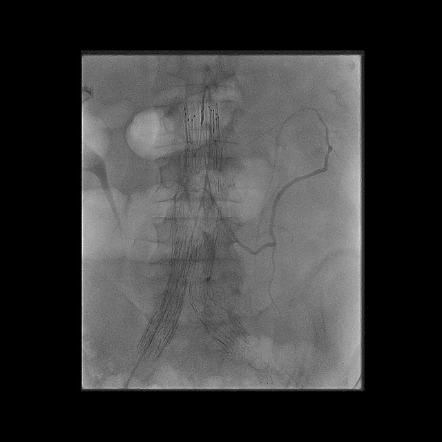 The Pump and the Tubes: Arc of Riolan / "meandering mesenteric artery"