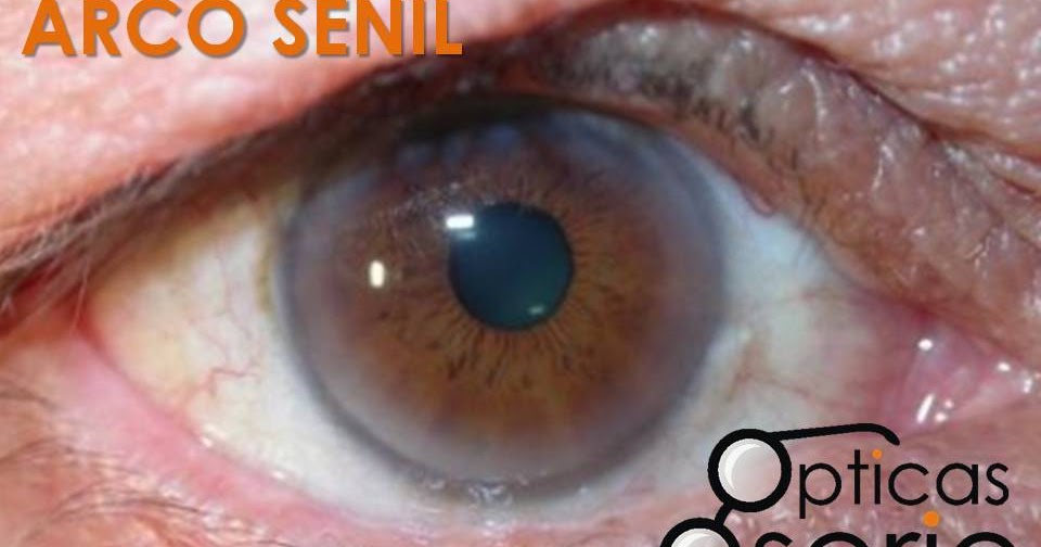 Ópticas Osorio : Arco Senil