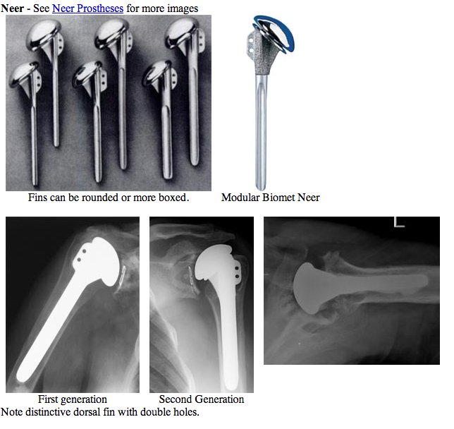 Shoulder and Elbow Surgery: Identifying the implanted shoulder ...
