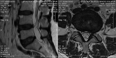 Dr Balaji Anvekar FRCR: Disc tear MRI Spine