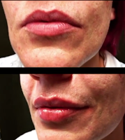 Selston Cosmetic Clinic: Beautiful Natural Looking Enhanced Lips at ...