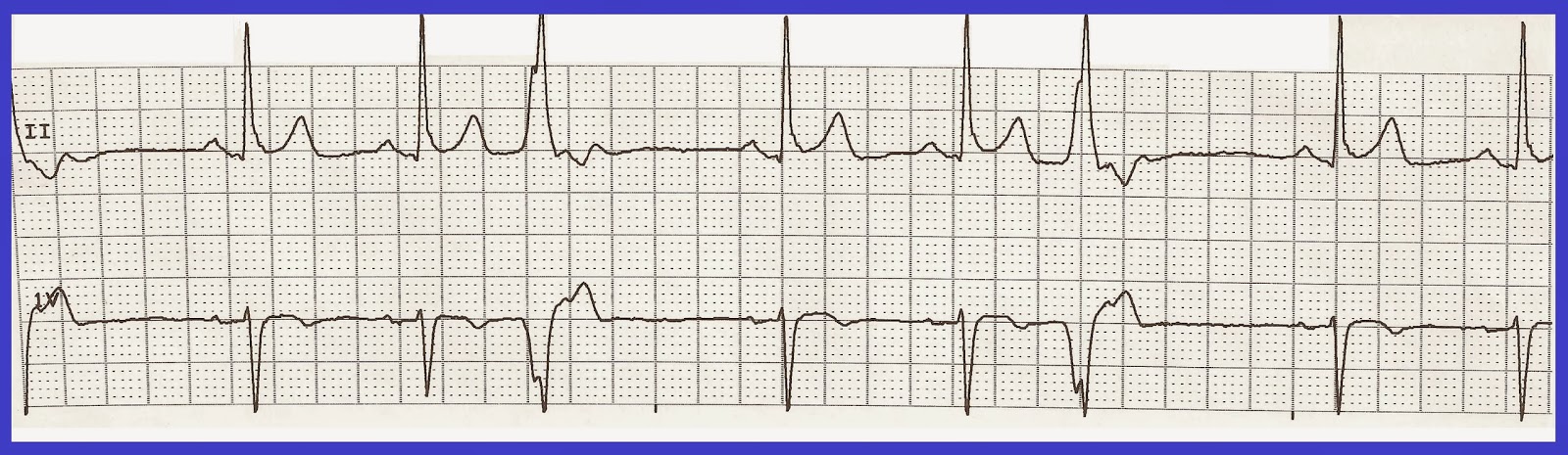 Practice EKG Rhythm Strips 213