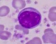 HEMATOLOGÍA: Plaquetas, Monocitos y Linfocitos