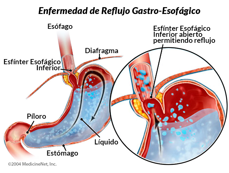 Fisiopatología: Fisiopatología de ERGE
