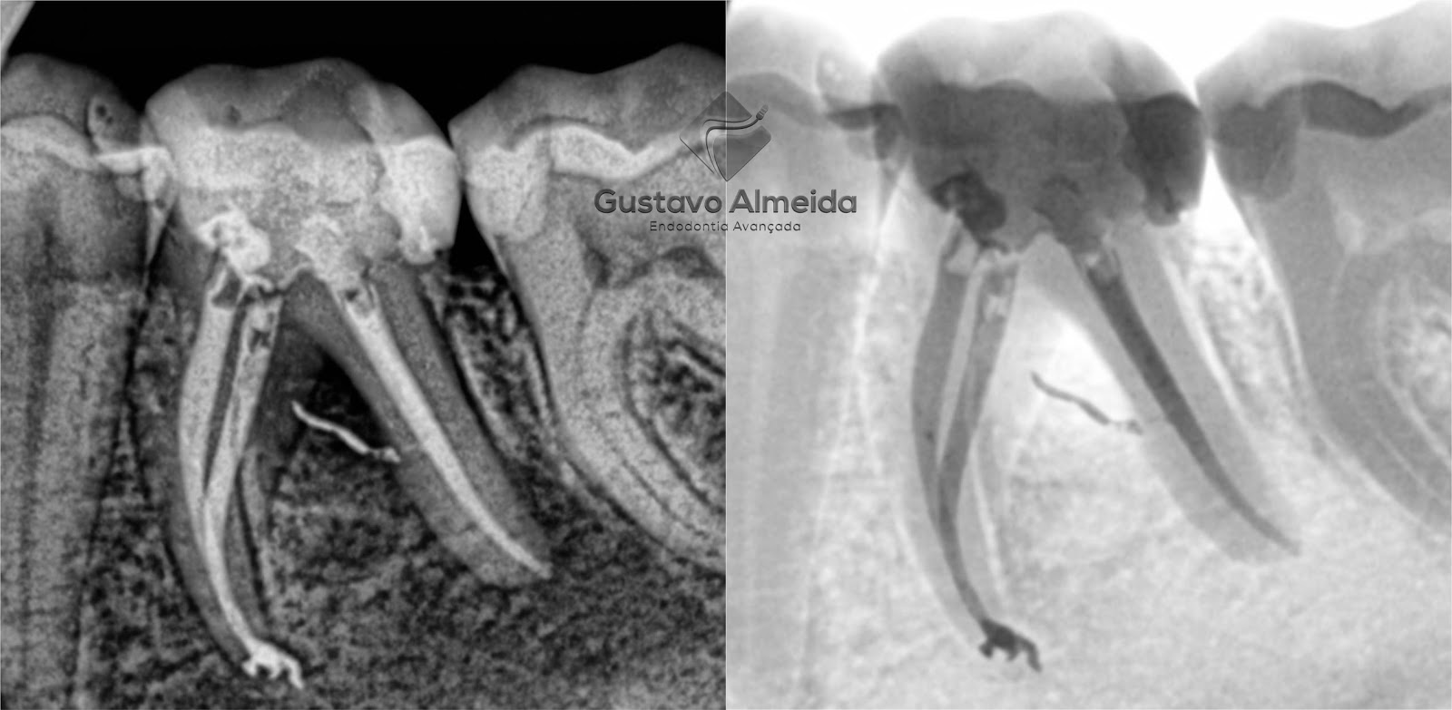 Lesão De Furca Dente - RETOEDU