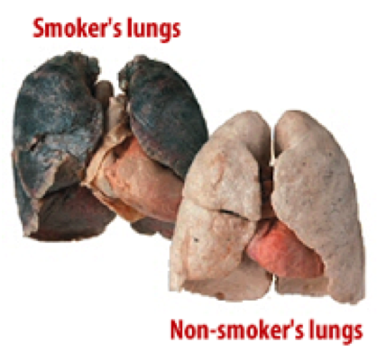 Secondhand Smoke Lungs