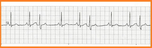 Basic EKG Rhythm Test 32