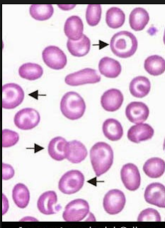 FICHERO DE HEMATOLOGIA: ANORMALIDADES DE LAS CÉLULAS SANGUINEAS