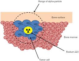 Prostate cancer - Our journey!: Radium 223 for targeting prostate cancer