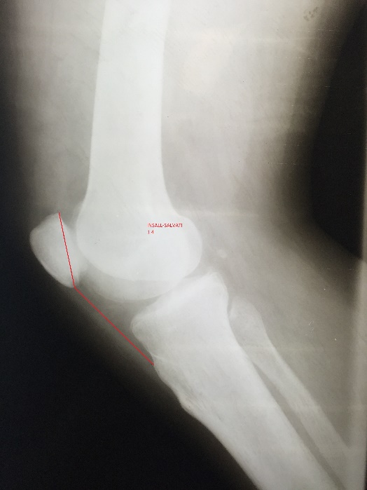 O R T O C R I T I C A: Inestabilidad rotuliana bilateral