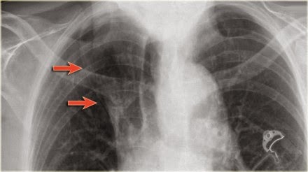 Chest Medicine Made Easy-Dr Deepu: Chest X Ray Part 1- Normal Anatomy ...