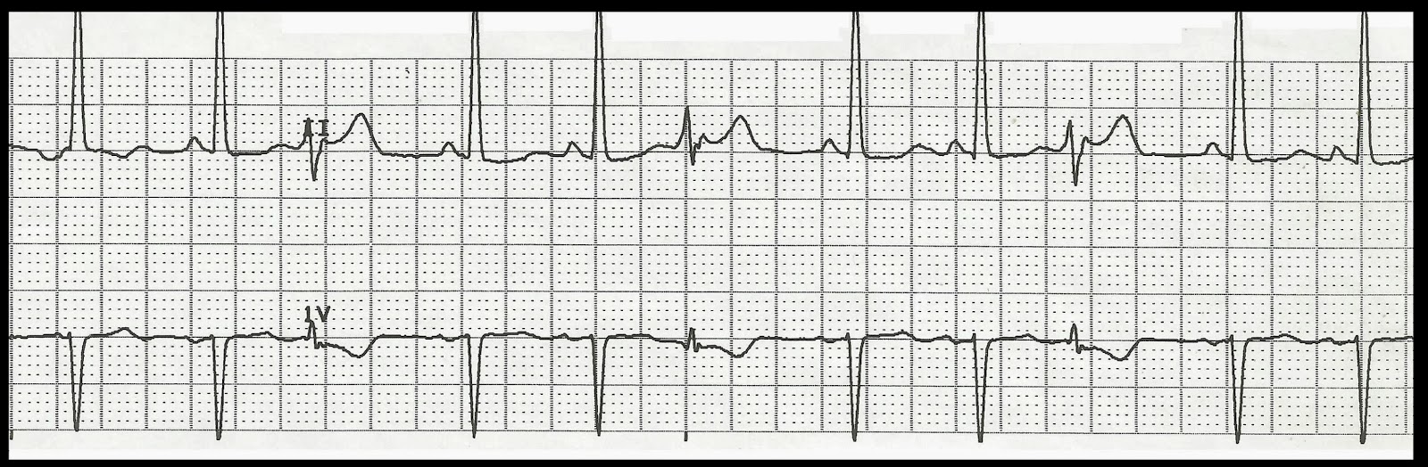 Practice EKG Rhythm Strips 211