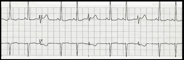 Practice EKG Rhythm Strips 211